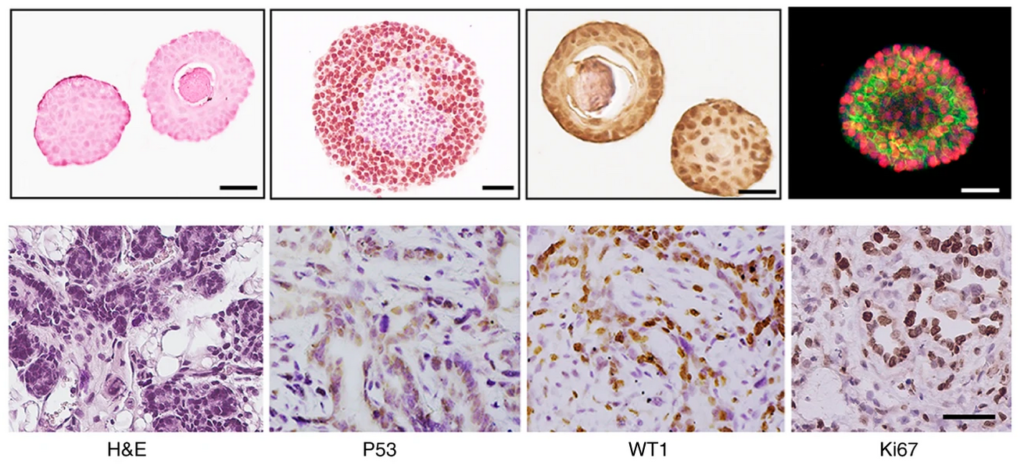 Both Fallopian Tube And Ovarian Surface Epithelium Are Cells Of Origin